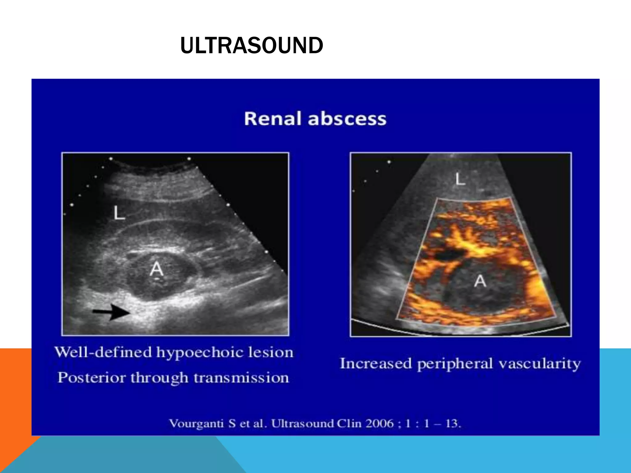 renal abscess by waheed | PPTX