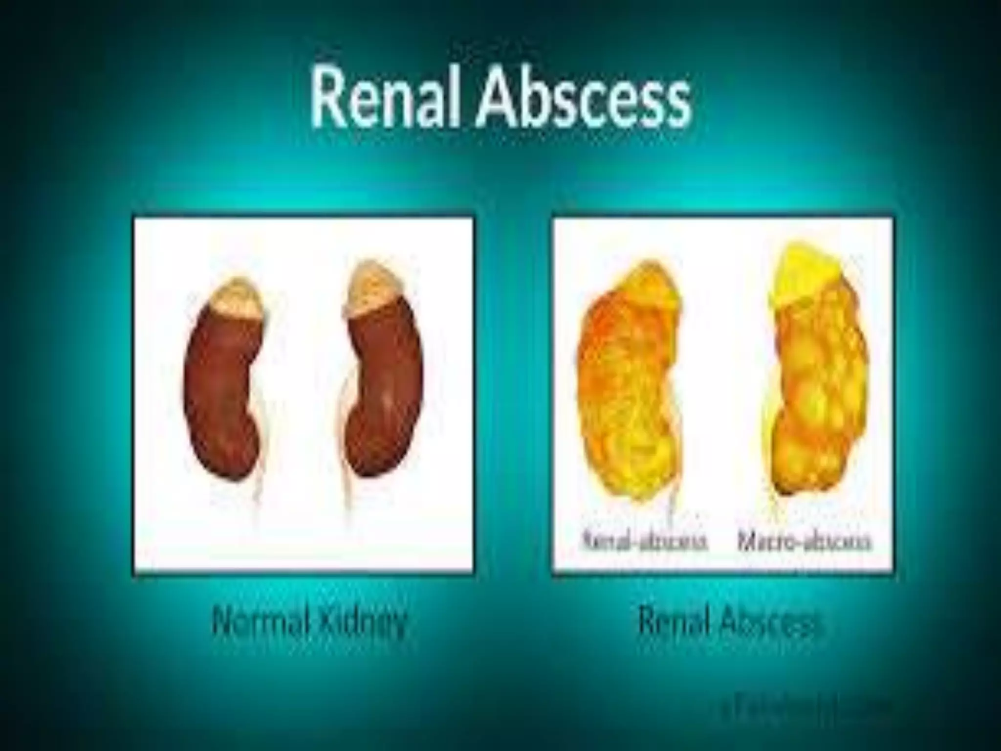 renal abscess by waheed | PPTX