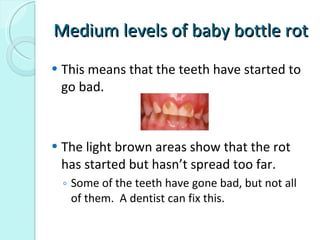 Zanzonico baby bottle rot | PPT