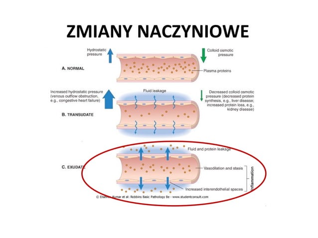 Zapalenia patogeneza | PPT