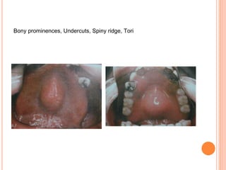 improvingdenture bearing foundation | PPTX
