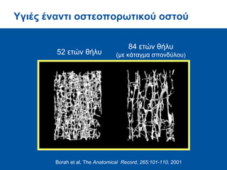 Διάγνωση και θεραπεία της οστεοπόρωσης σε ασθενείς με ΙΦΝΕ | PPT