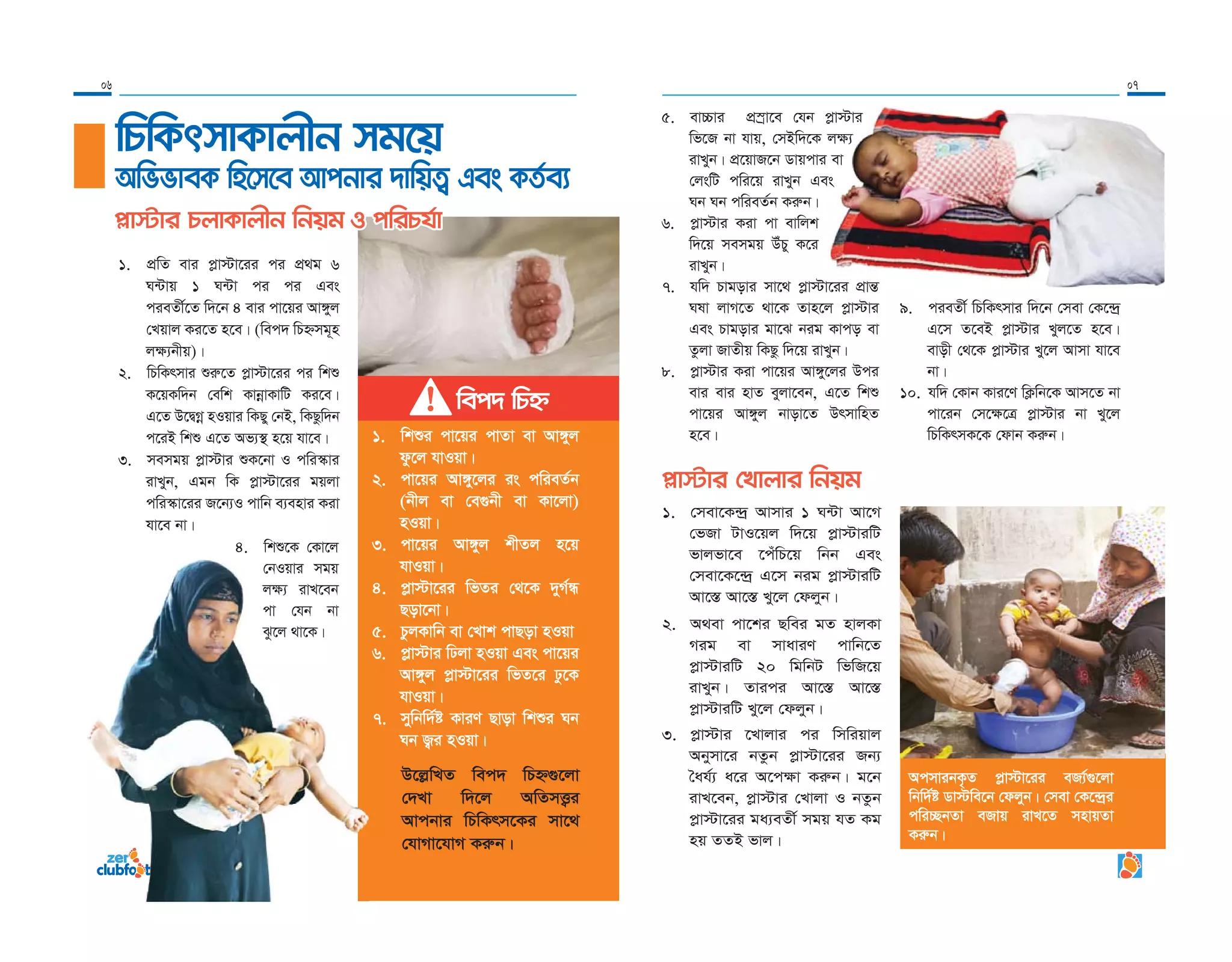 Clubfoot Treatment Guideline | PDF