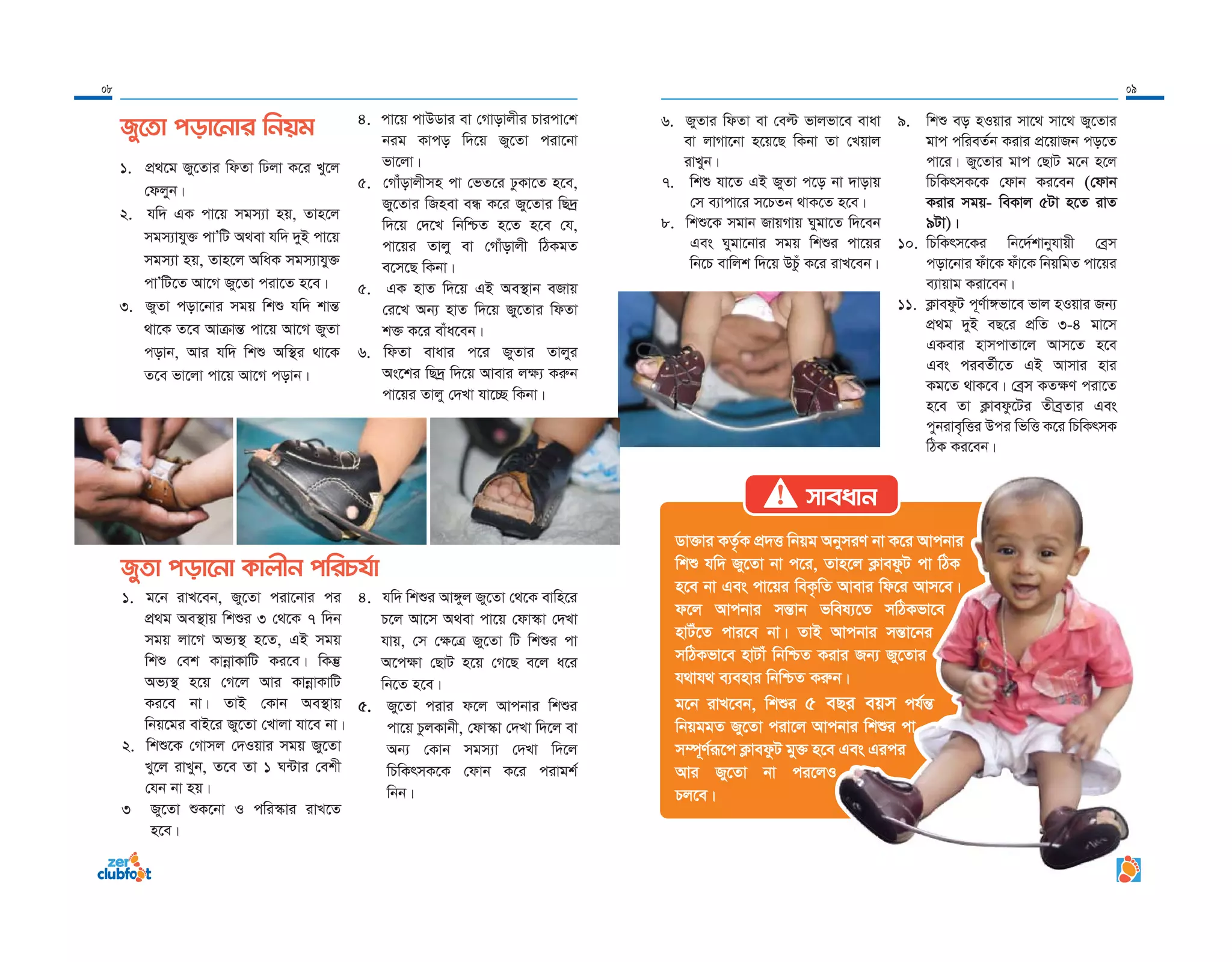 Clubfoot Treatment Guideline | PDF
