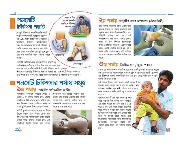 Clubfoot Treatment Guideline | PDF
