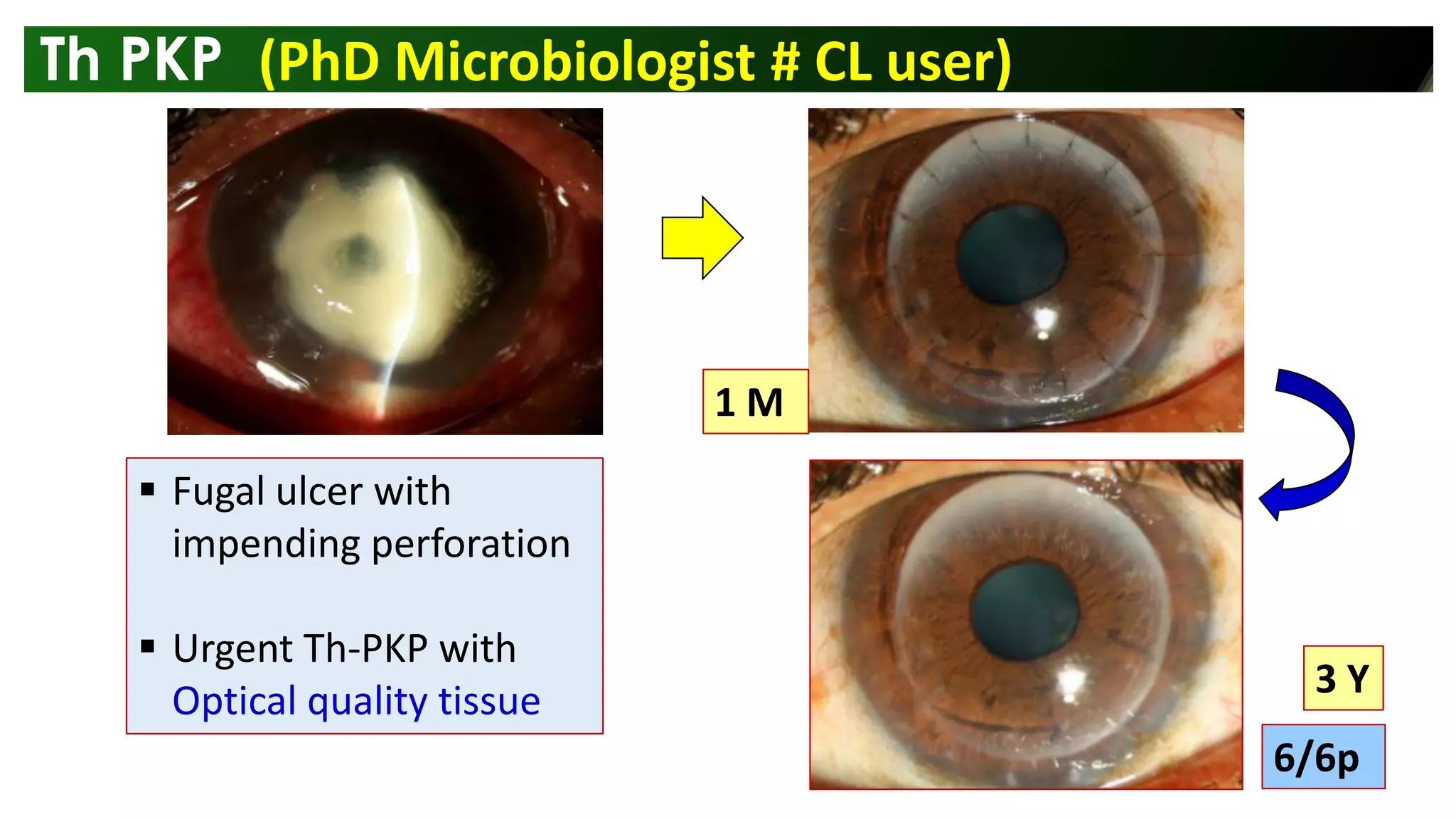 Corneal Blindness - Eye Banking in India and Task Ahead | PPTX