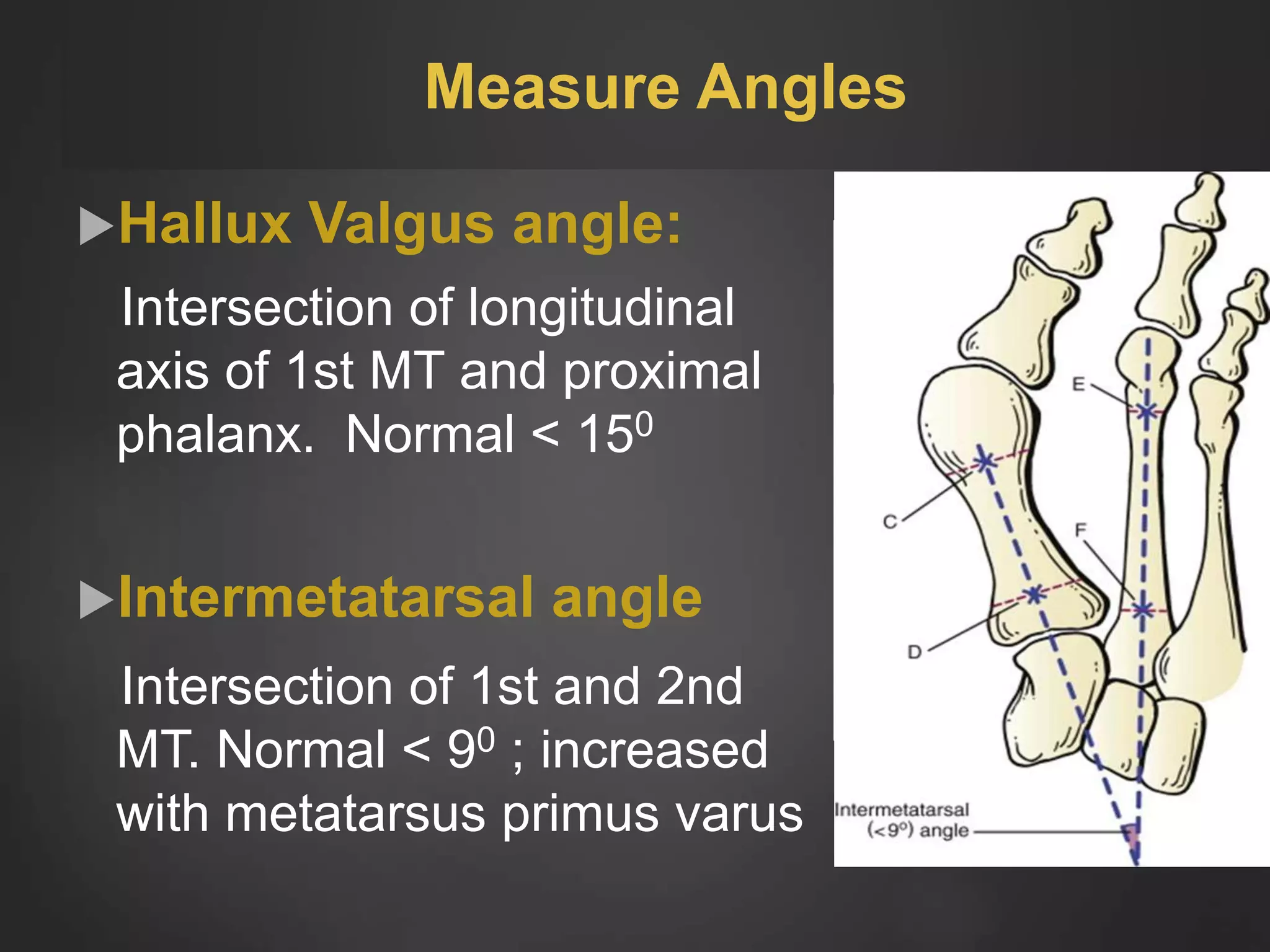 Hallux valgus | PPTX