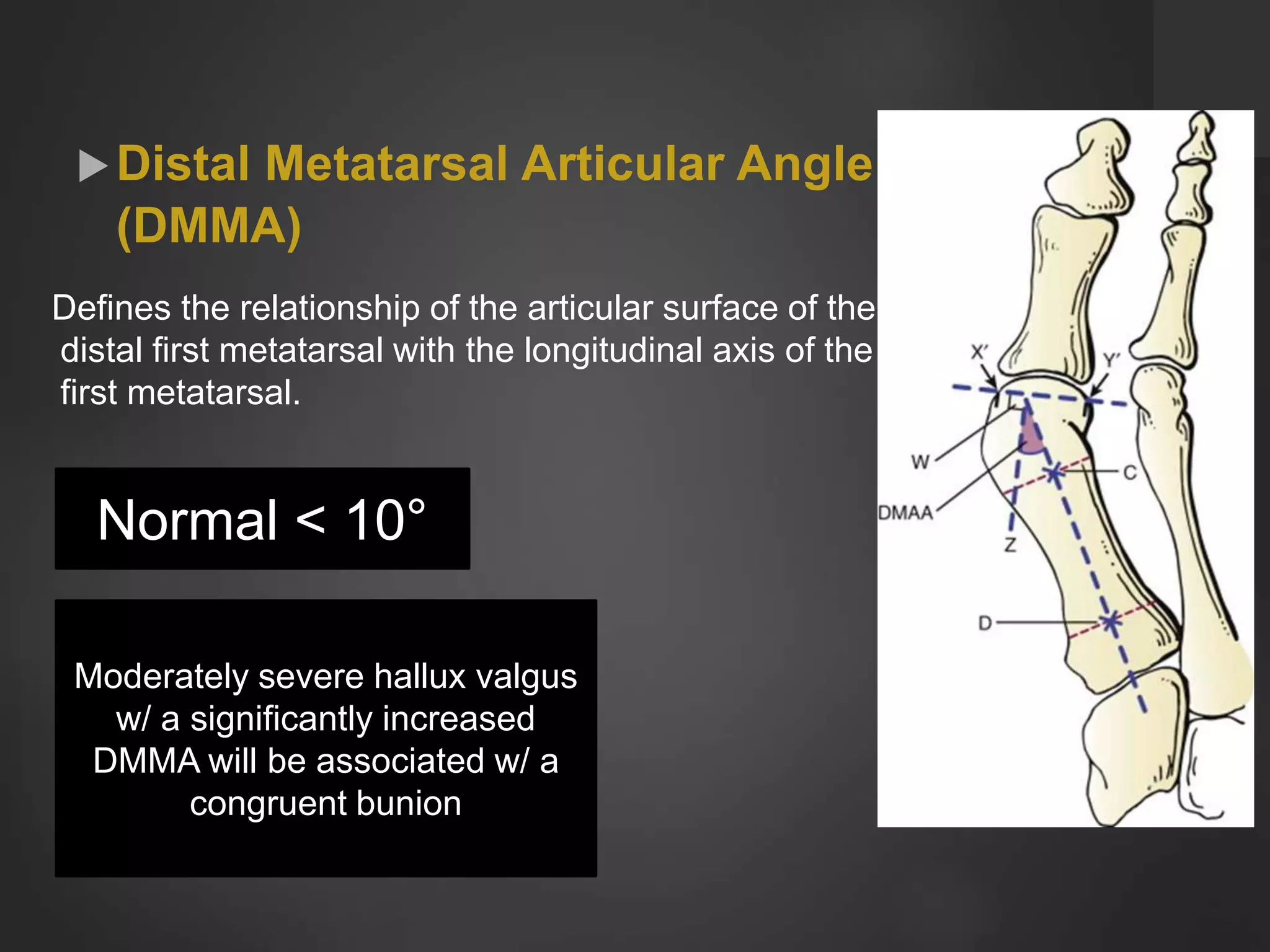 Hallux valgus | PPTX
