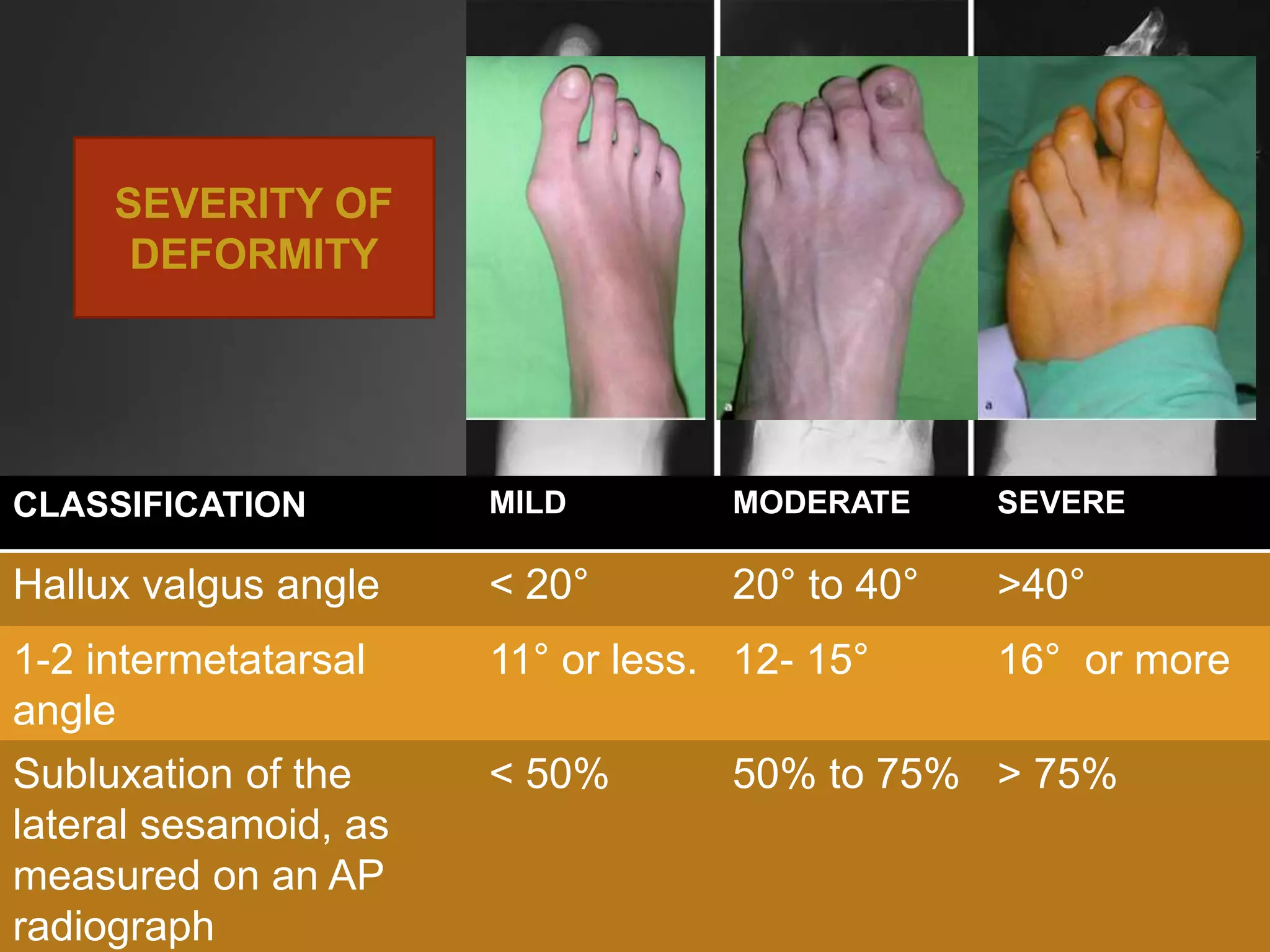 Hallux valgus | PPTX
