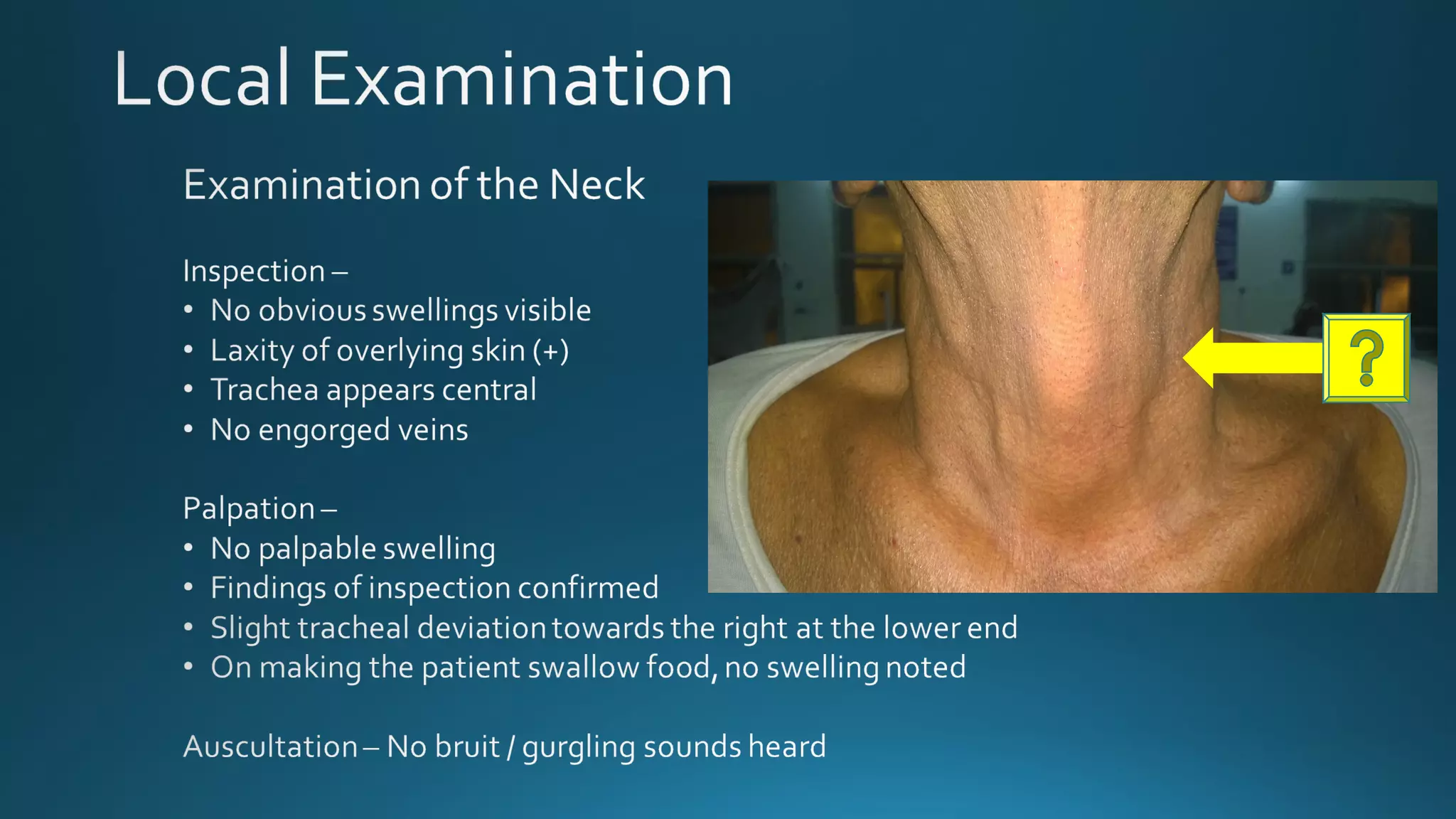 Zenkers DIverticulum | PPT