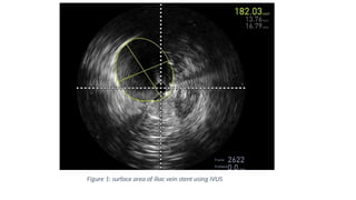 Zero contrast venous stent and intervention | PPTX