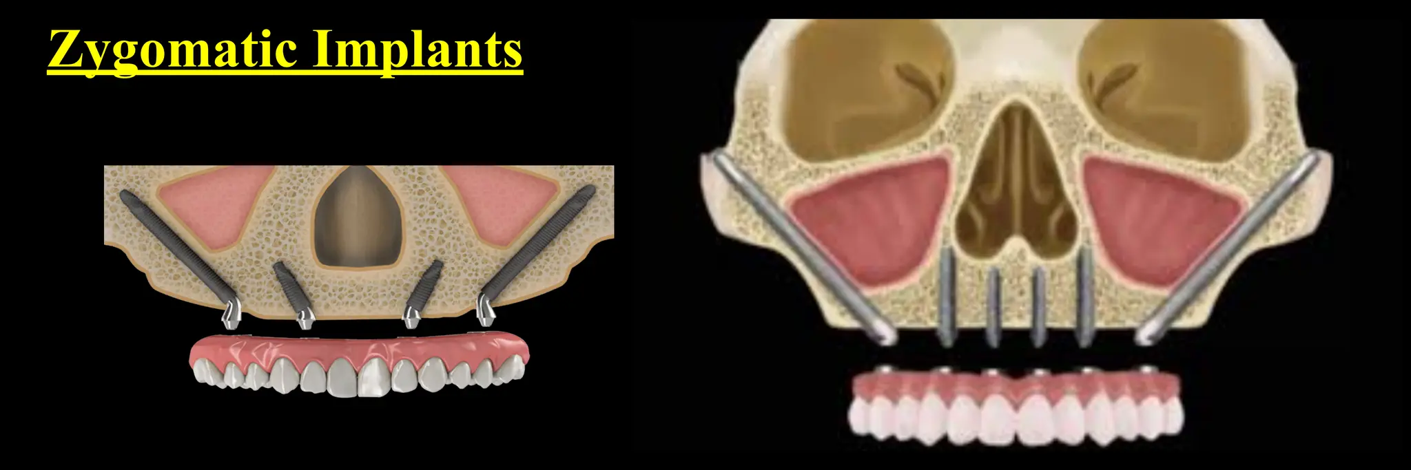 zero maxilla zygomatic impant subperiosteal implant | PDF