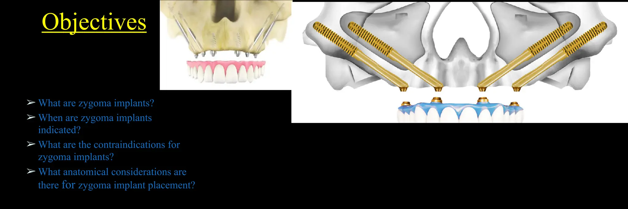 zero maxilla zygomatic impant subperiosteal implant | PDF