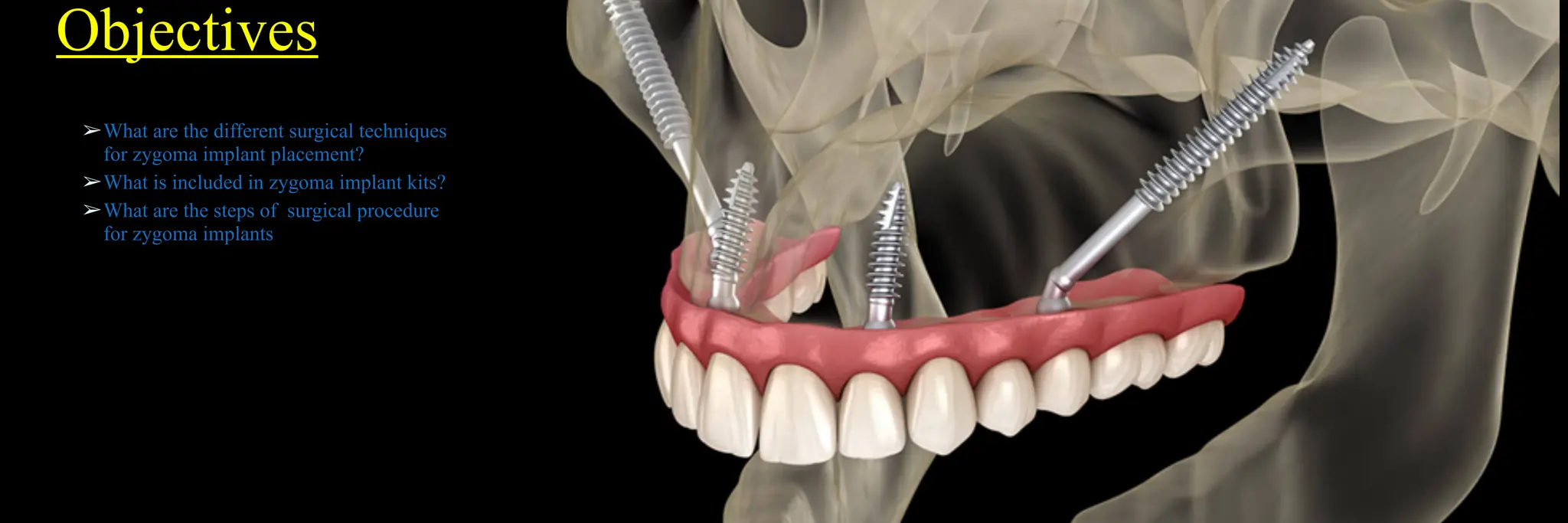 zero maxilla zygomatic impant subperiosteal implant | PDF