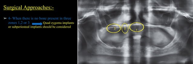 zero maxilla zygomatic impant subperiosteal implant | PPT