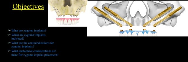 zero maxilla zygomatic impant subperiosteal implant | PPT
