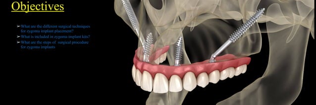 zero maxilla zygomatic impant subperiosteal implant | PPT