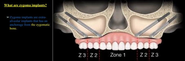 zero maxilla zygomatic impant subperiosteal implant | PPT
