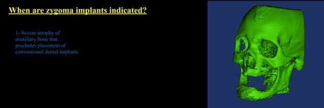 zero maxilla zygomatic impant subperiosteal implant | PPT