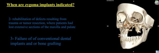 zero maxilla zygomatic impant subperiosteal implant | PPT