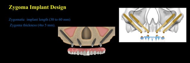 zero maxilla zygomatic impant subperiosteal implant | PPT