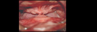 zero maxilla zygomatic impant subperiosteal implant | PDF
