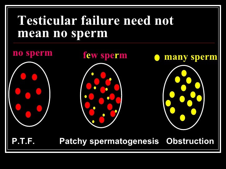 Zero Sperm Count What The Gynecologist Should Know By Dr Rupin Shah…