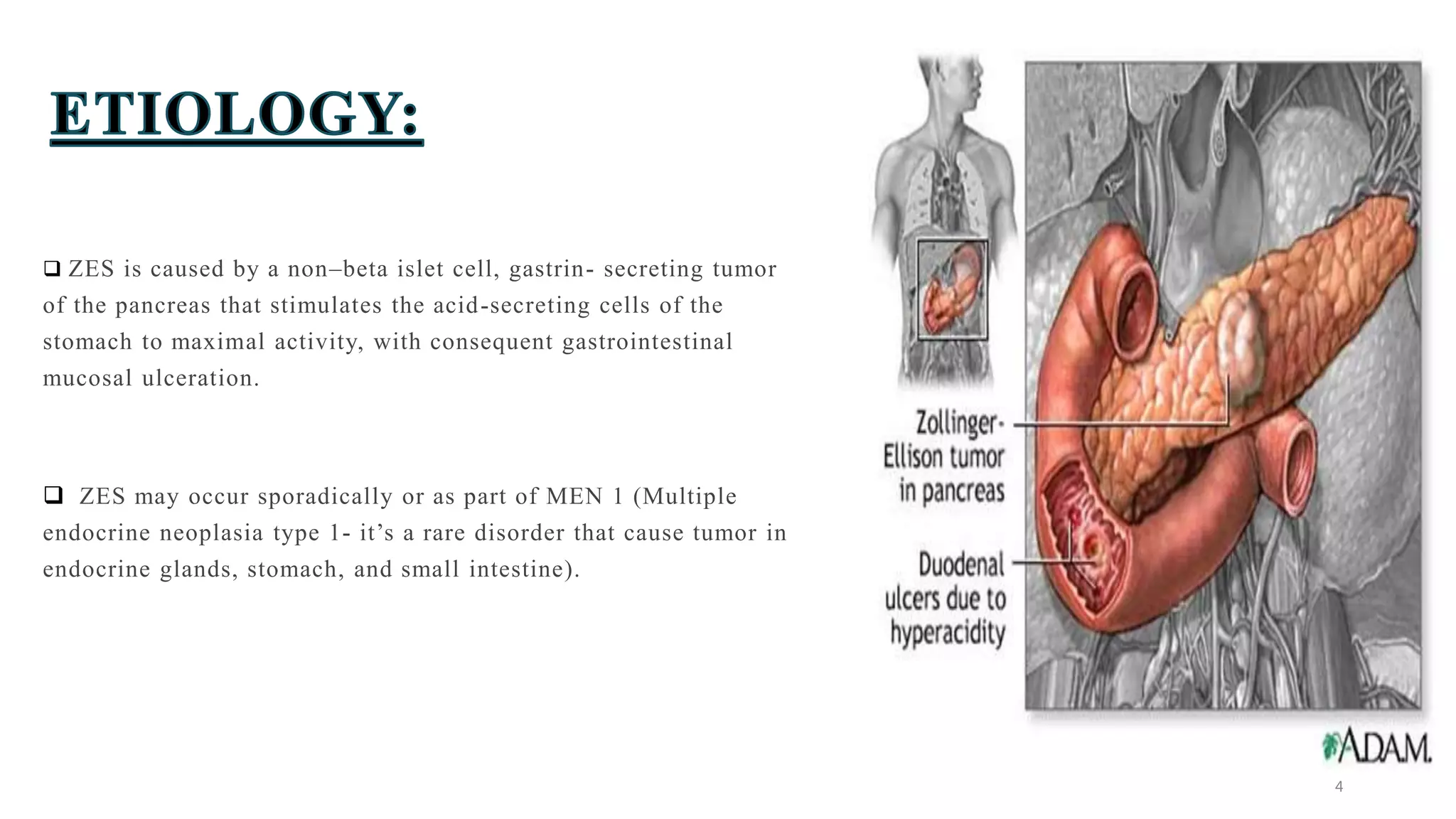 ZOLLINGER ELLISON SYNDROME. | PPTX
