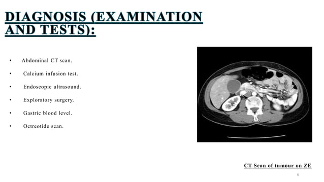 ZOLLINGER ELLISON SYNDROME. | PPTX