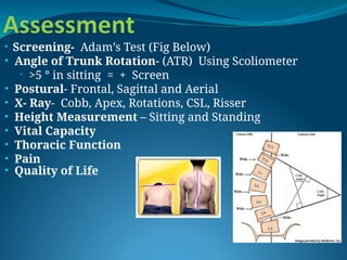 zf4 Spinal deformites from thoracic to lumbar.ppt