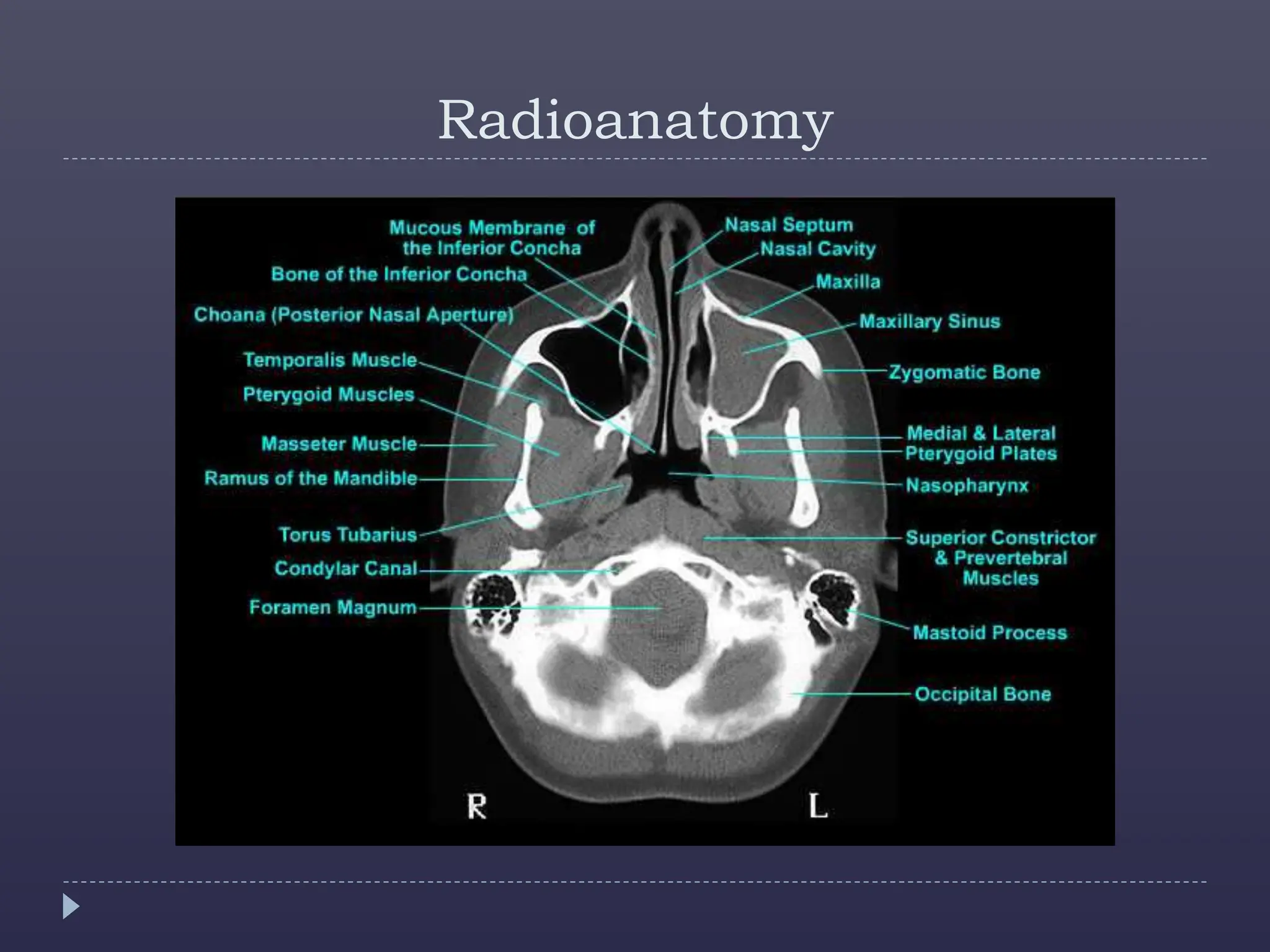 Nasopharyngeal carcinoma an importamnt cancer of nasopharynx | PPT ...