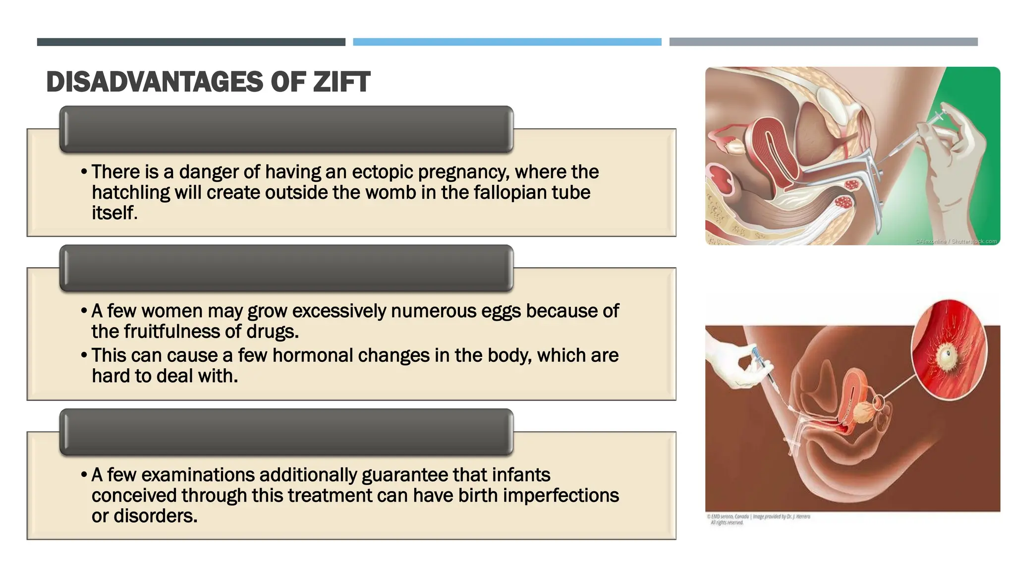 zygote interfelloporin transfer. Z*FT ppt | PDF | Pregnancy ...
