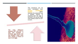 zygote interfelloporin transfer. Z*FT ppt | PDF | Pregnancy ...