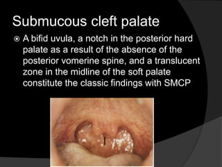Bifid Uvula Submucous Cleft Palate