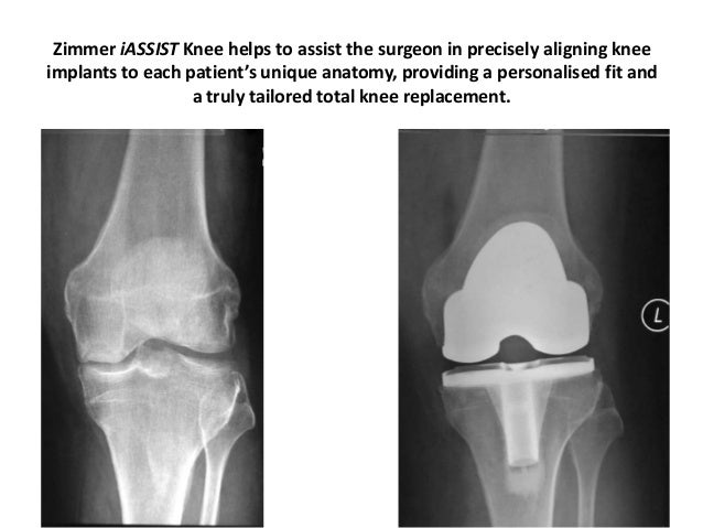 Zimmer i assist knee surgical assistance for total
