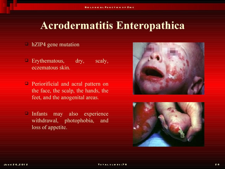 Zinc Deficiency Baby Rash at Ashley Pines blog