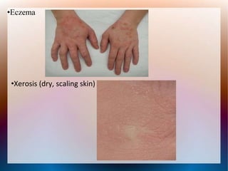 Zinc Deficiency | PPTX