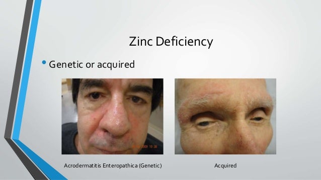 MMP's and the Role of Zinc in Wound Healing