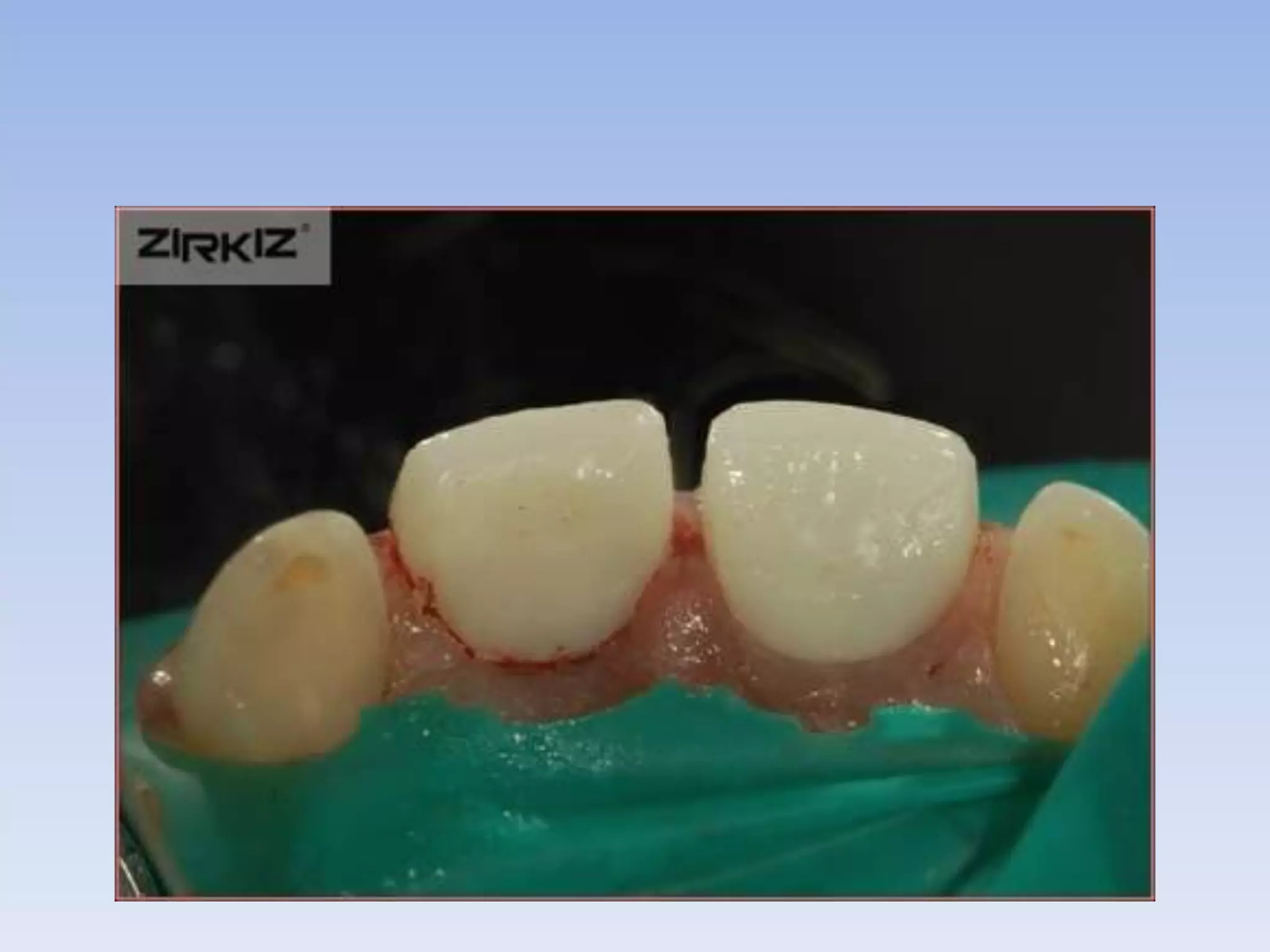 Zirconia crowns for primary anterior and posterior teeth | PPTX