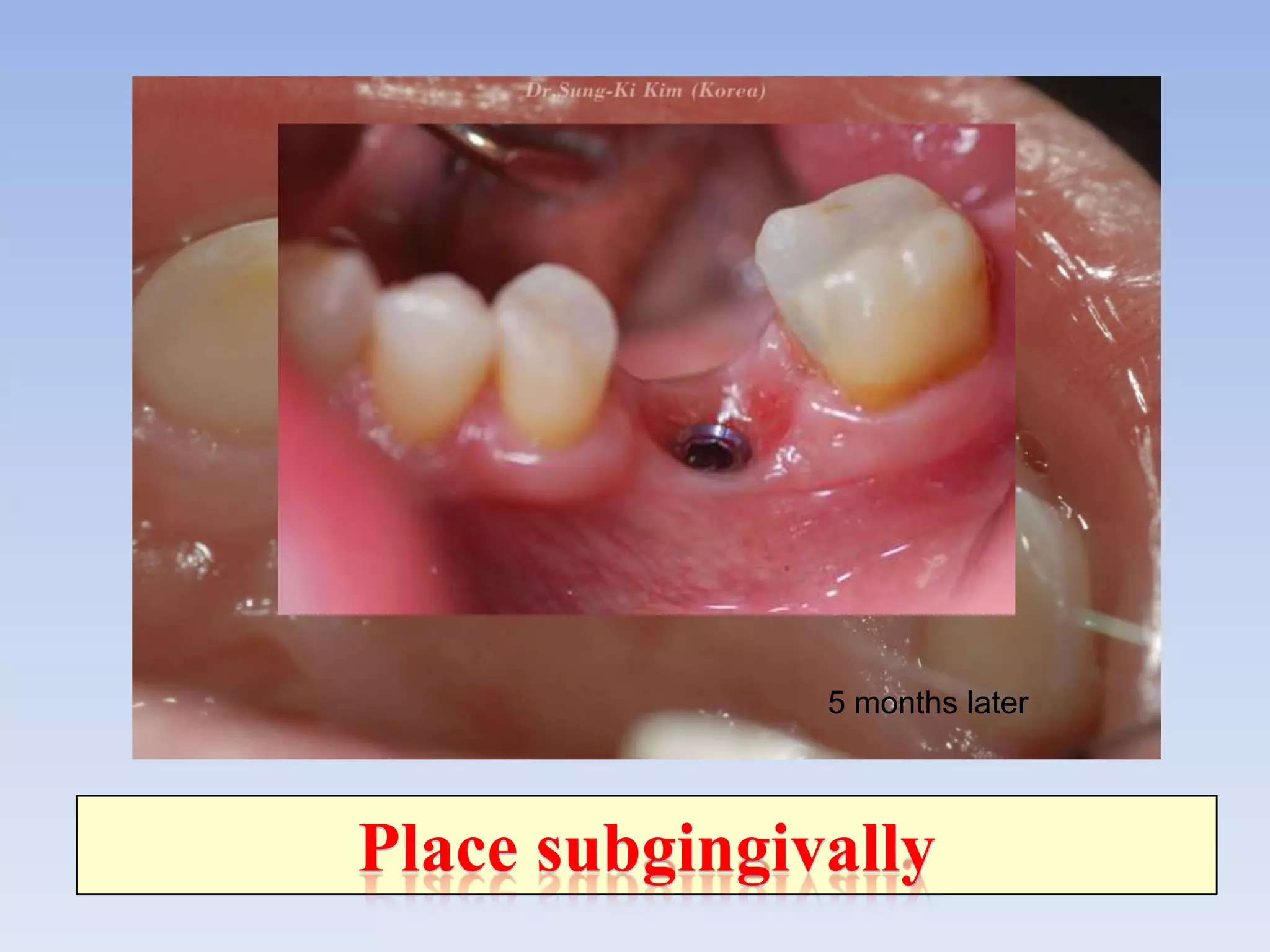 Zirconia crowns for primary anterior and posterior teeth | PPTX