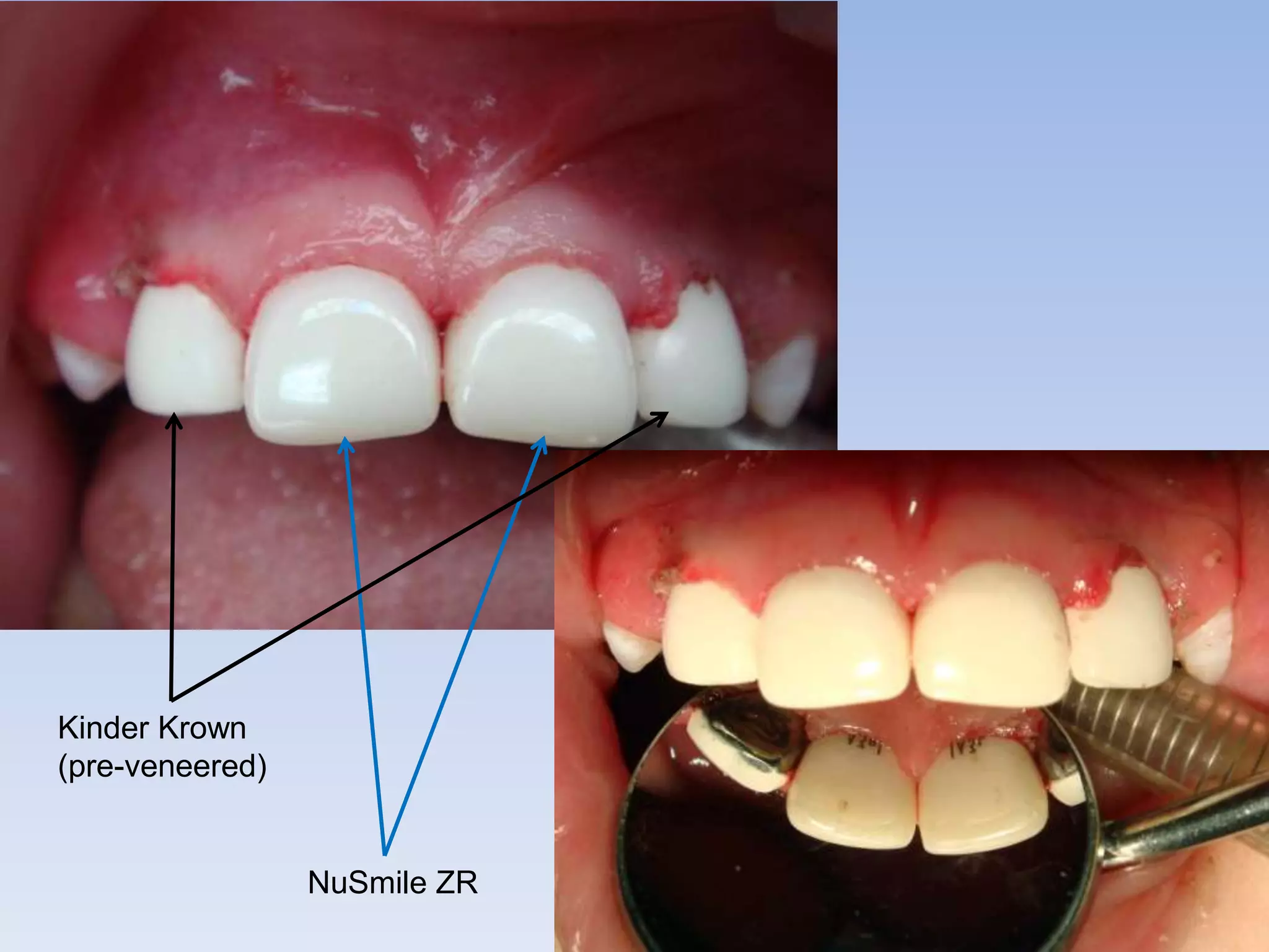 Zirconia crowns for primary anterior and posterior teeth | PPTX