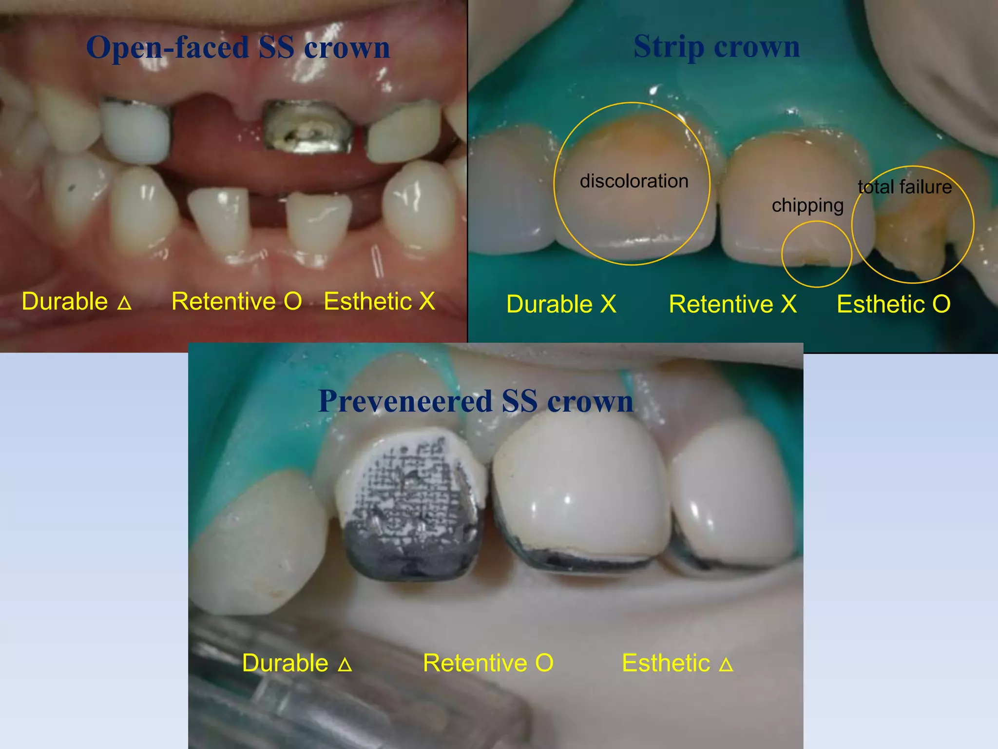 Zirconia crowns for primary anterior and posterior teeth | PPTX