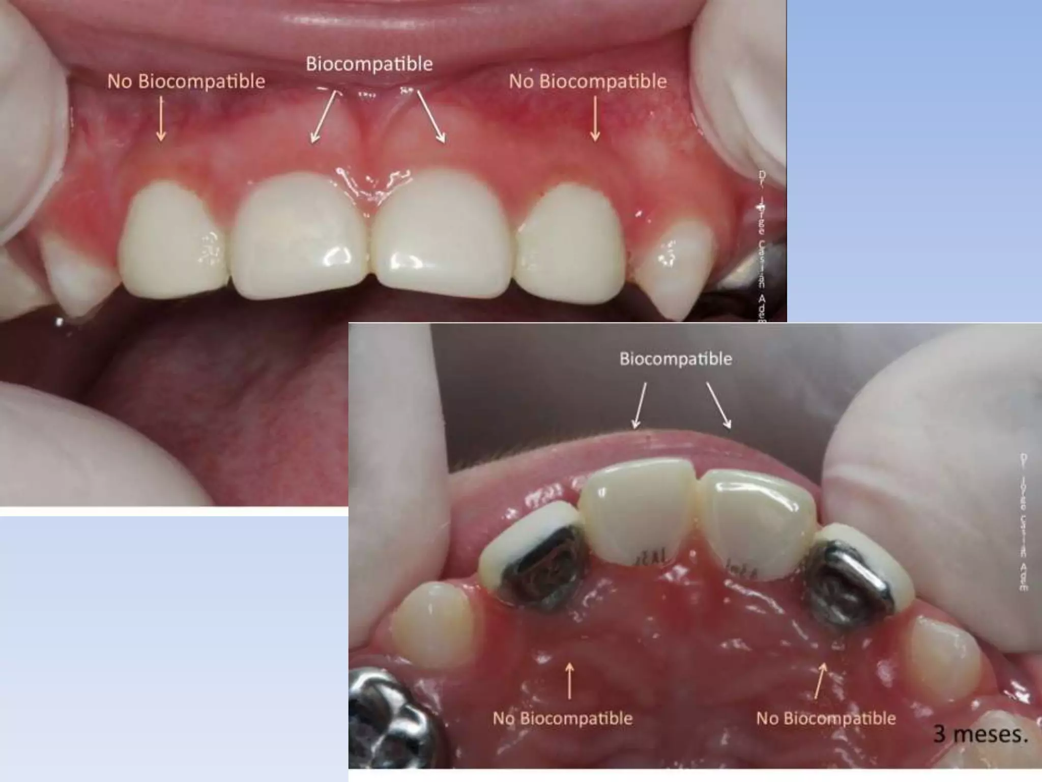 Zirconia crowns for primary anterior and posterior teeth | PPTX