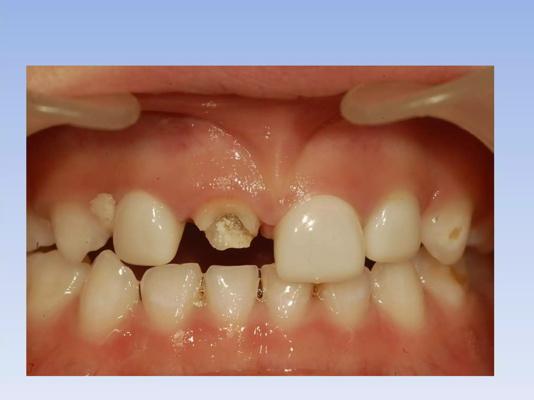 Zirconia crowns for primary anterior and posterior teeth | PPTX