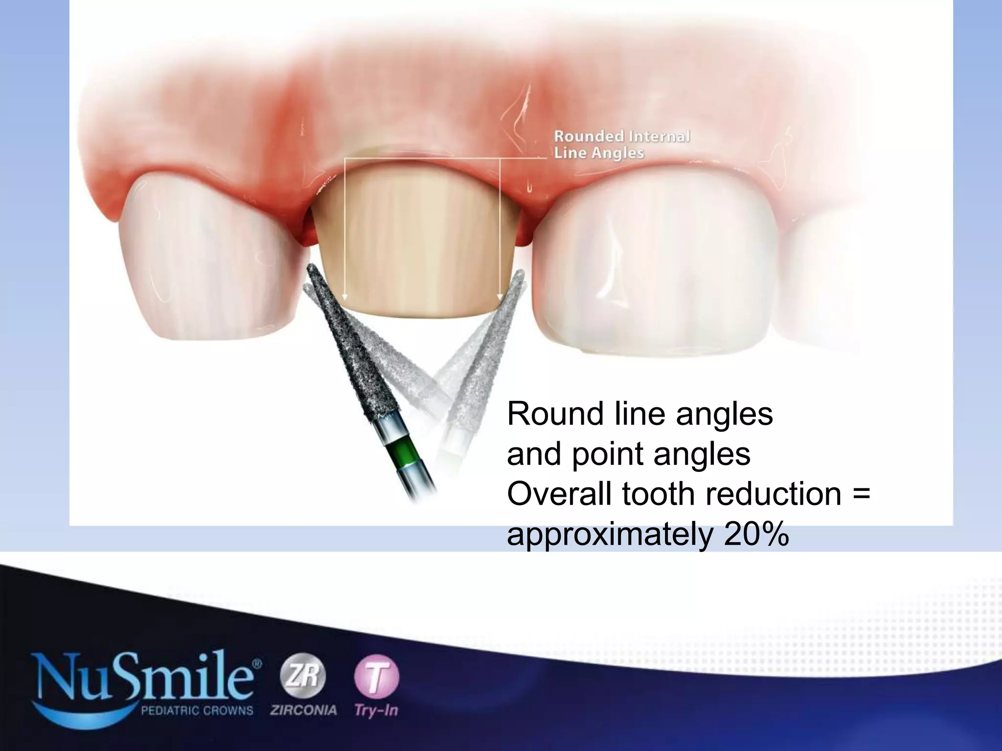 Zirconia crowns for primary anterior and posterior teeth | PPTX