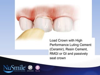 Zirconia crowns for primary anterior and posterior teeth | PPTX
