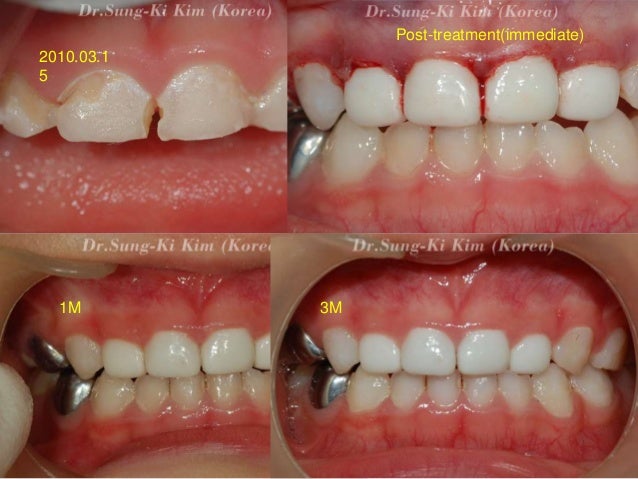 Zirconia crowns for primary anterior and posterior teeth