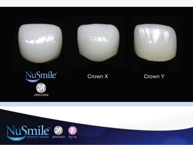 Zirconia crowns for primary anterior and posterior teeth
