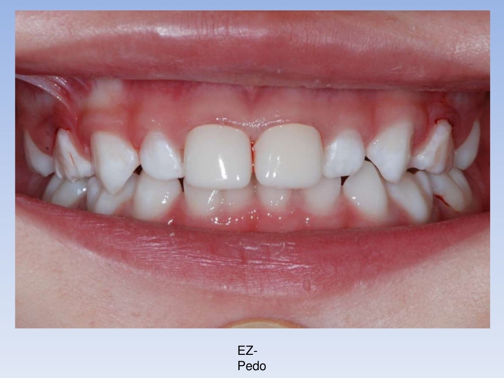 Zirconia crowns for primary anterior and posterior teeth