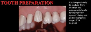 Tooth Preparation - Zirconia crowns | PDF